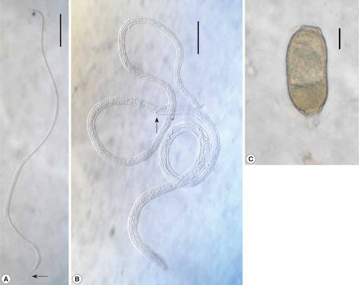 An Indigenous Case of Intestinal Capillariasis with Protein-Losing ...